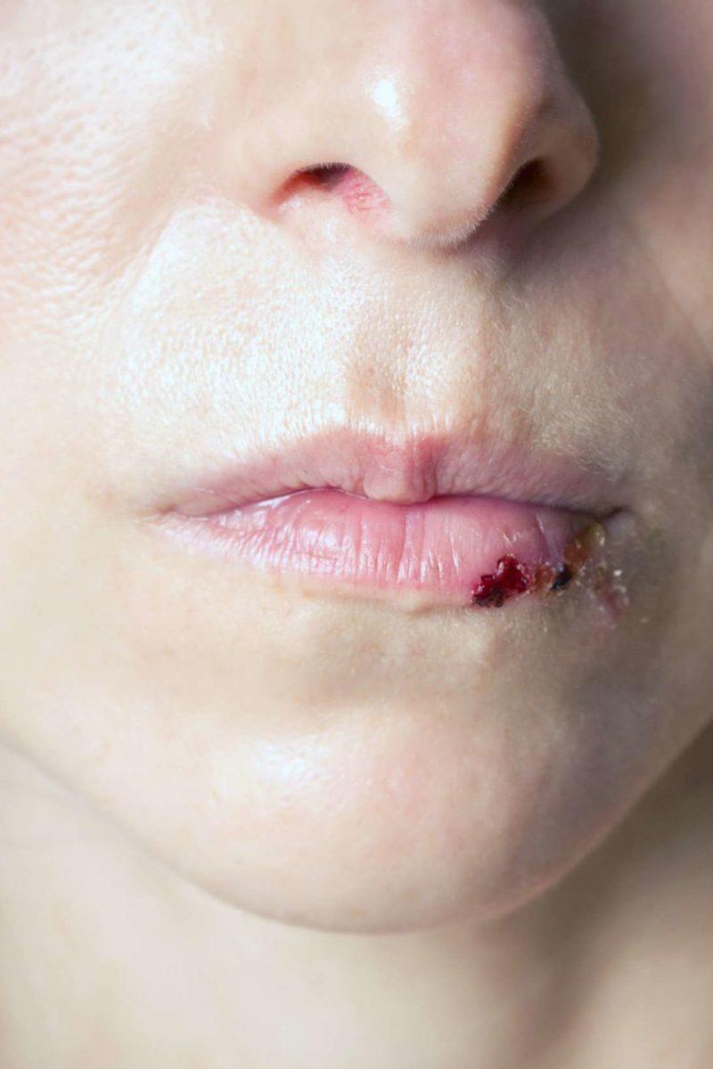 How to Stop a Lip Bleed? - the BEAUTIOUS